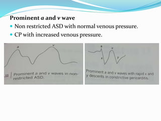 Jugular venous pressure | PPTX