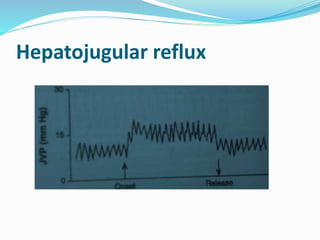 Jugular venous pressure | PPTX