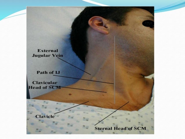 Jugular venous pressure