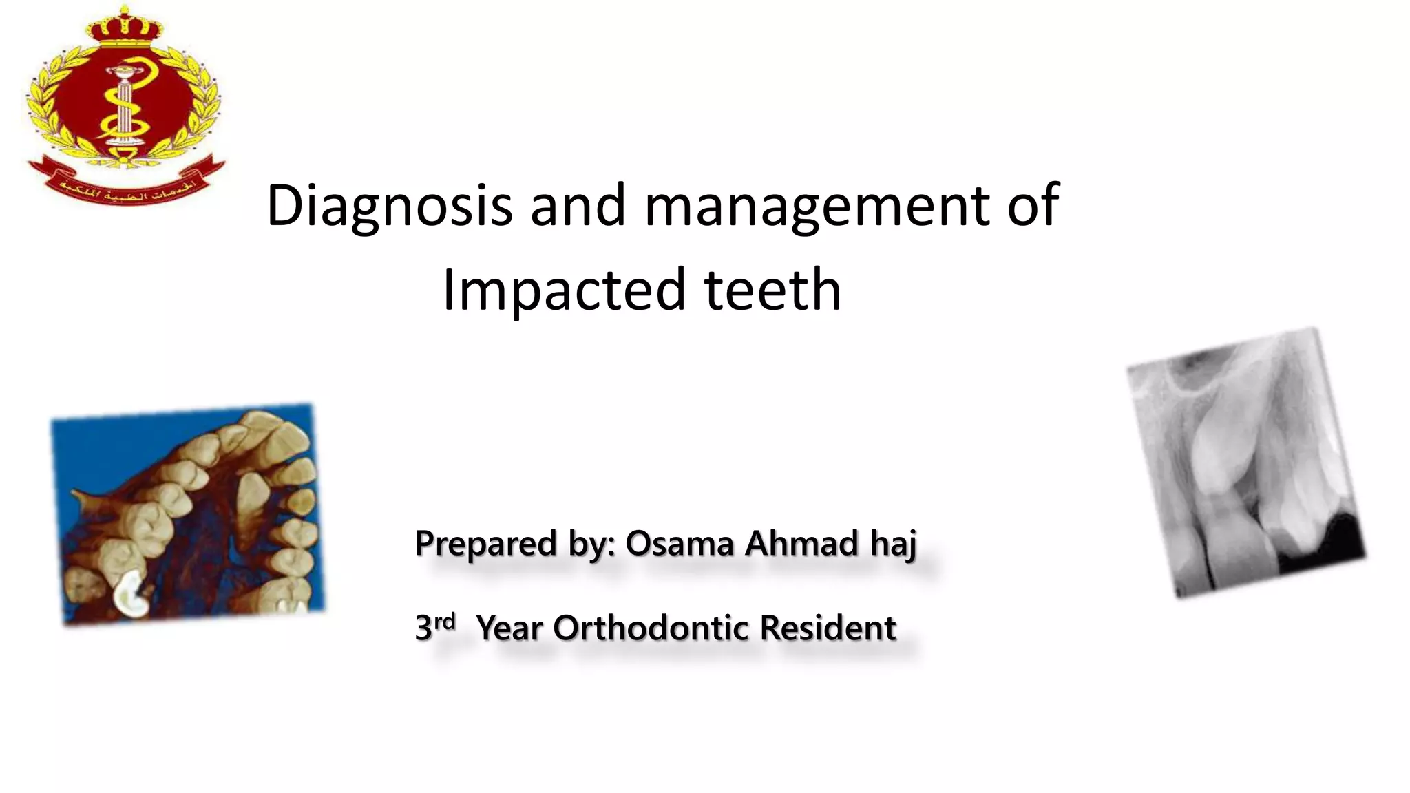 impacted teeth | PPTX