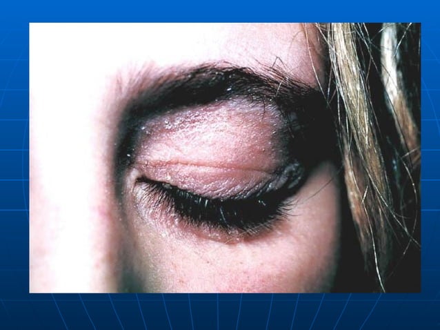 ATOPY | PPS | Skin and Dermatology | Diseases and Conditions