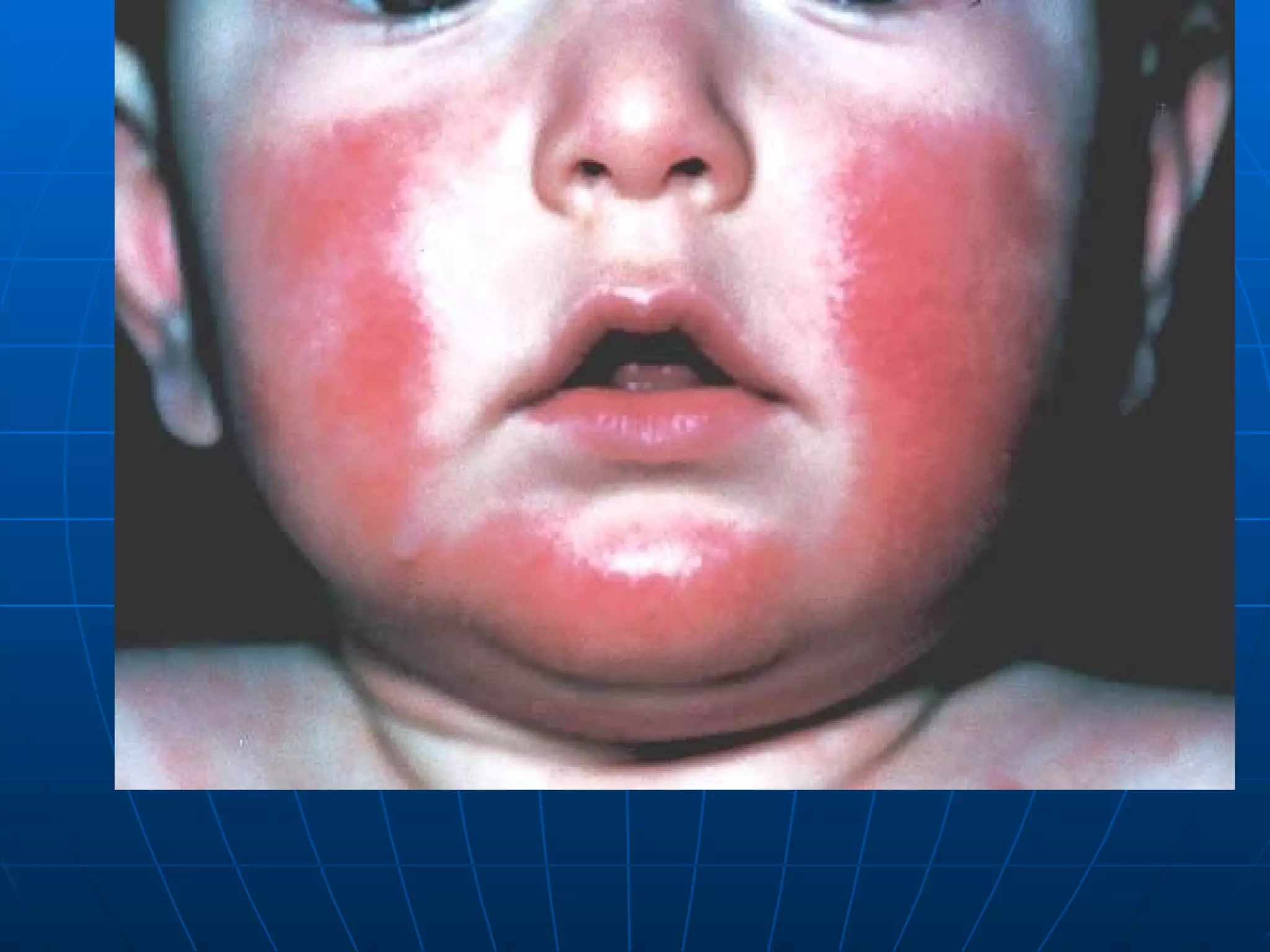 Atopic dermatitis | PPS