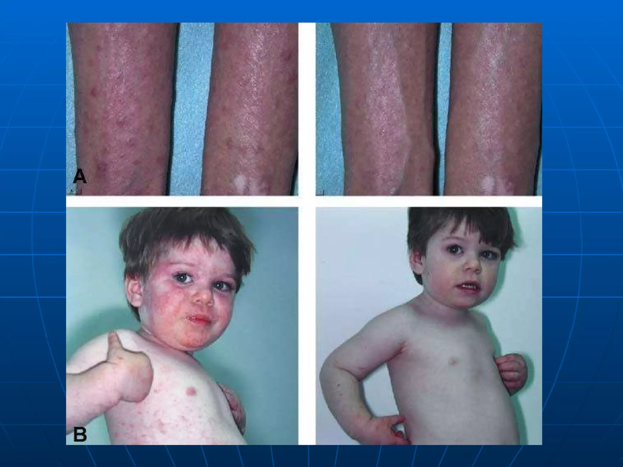 Atopic dermatitis | PPT