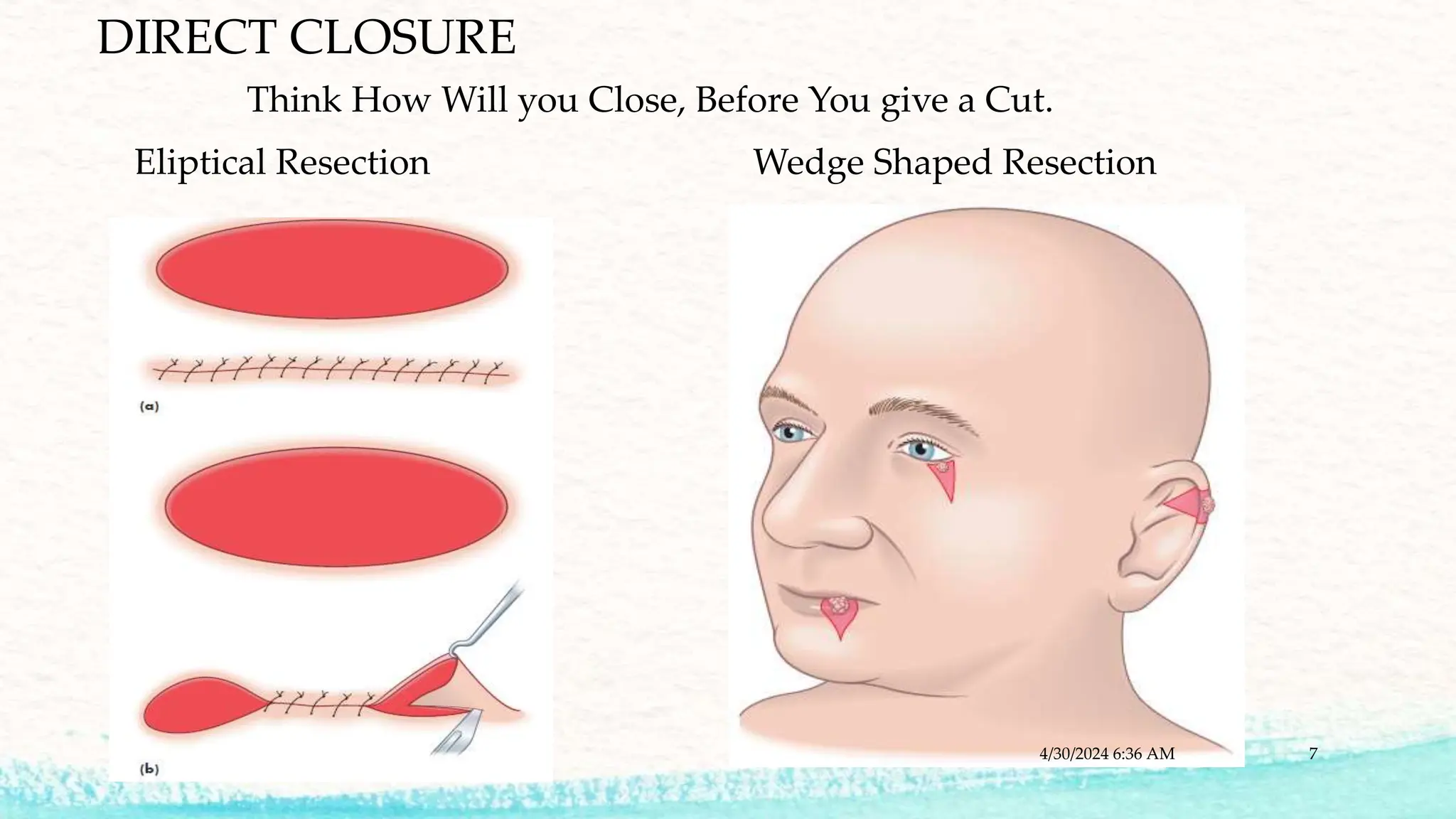 Local and regional flaps in head and neck.pptx