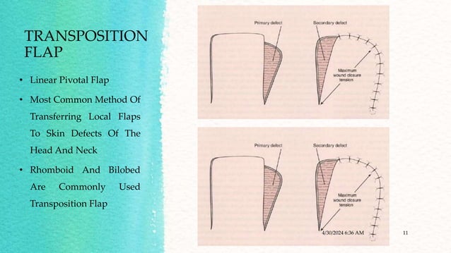 Local and regional flaps in head and neck.pptx