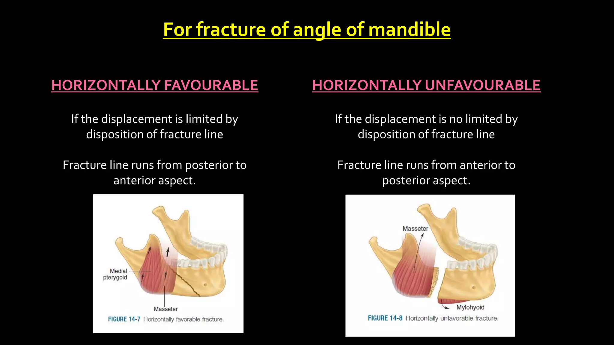 Mandible fracture by Dr. Shivani Taank | PPTX
