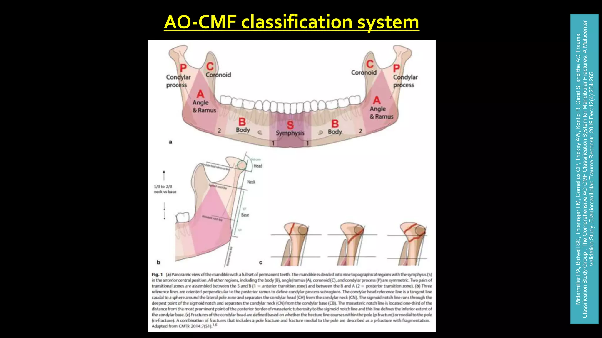 Mandible fracture by Dr. Shivani Taank | PPTX