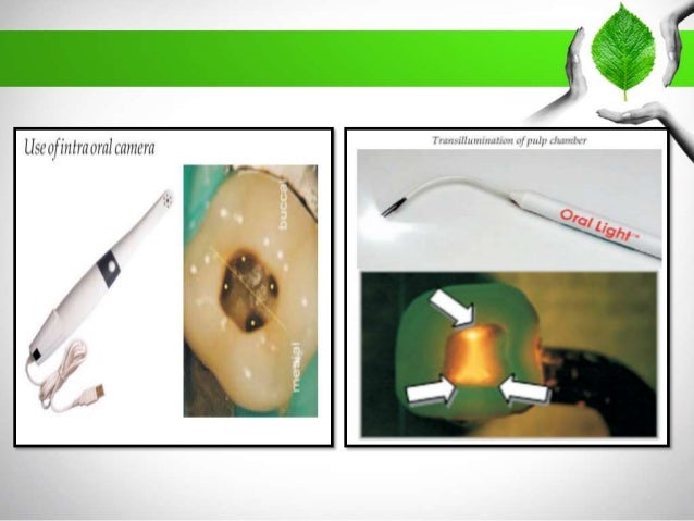 Endodontic mishaps - Dr. Jagadeesh kodityala