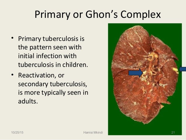 tuberculosis in children-Hamisi Mkindi
