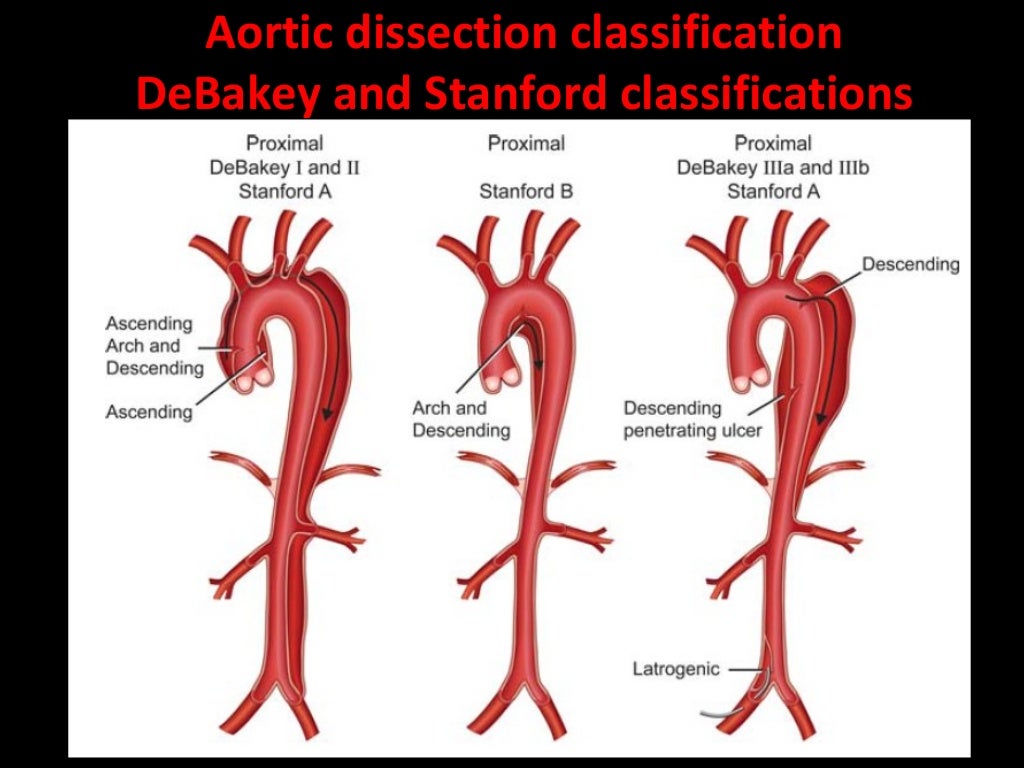 Acute Aortic syndrome