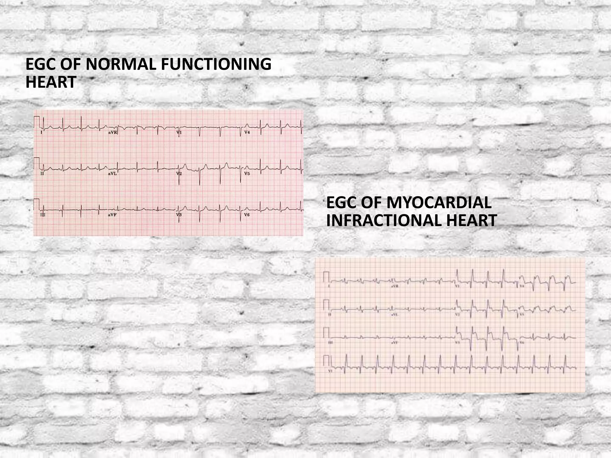 CARDIOVASCULAR SYSTEM, MYOCARDIAL INFRACTION AND LABORATORY DIAGNOSIS | PPT