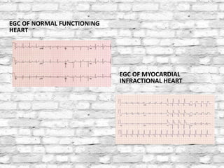 CARDIOVASCULAR SYSTEM, MYOCARDIAL INFRACTION AND LABORATORY DIAGNOSIS | PPT