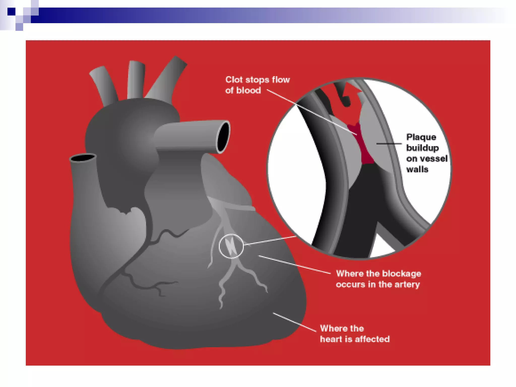 Myocardial Infarction | PPT