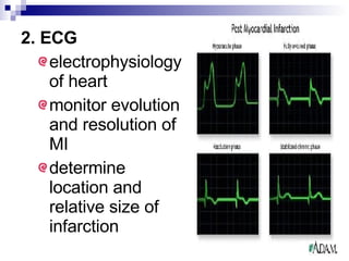 Myocardial Infarction | PPT