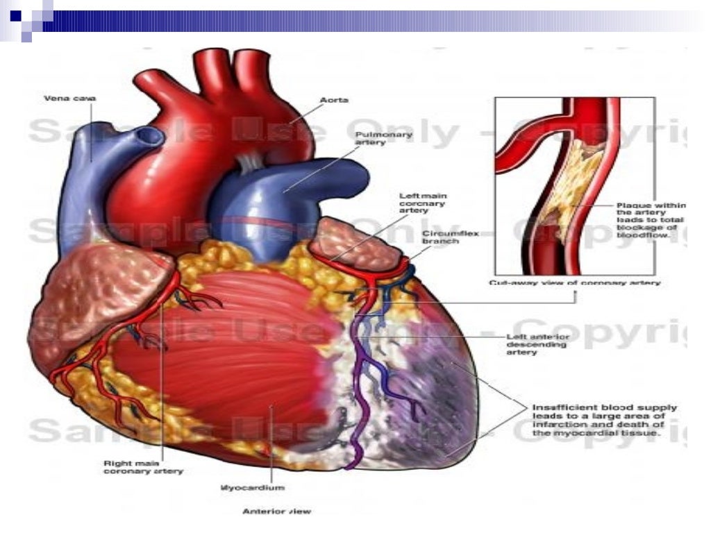 Myocardial Infarction