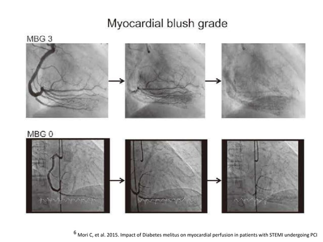 Myocardial Blush Coronary Artery Grading | PPTX