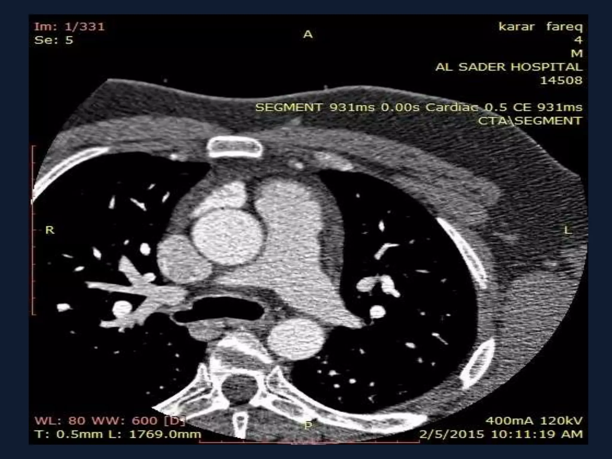 Myocardial bridge..case | PPTX