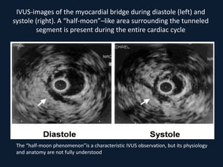 Myocardial bridge..case | PPTX