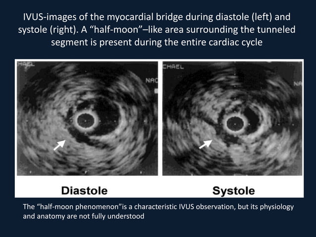 Myocardial bridge..case | PPTX | Heart and Cardiovascular Diseases ...