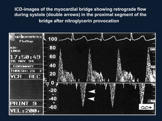 Myocardial bridge..case | PPTX