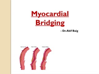 myocardial bridging for coronary evaluation | PPTX