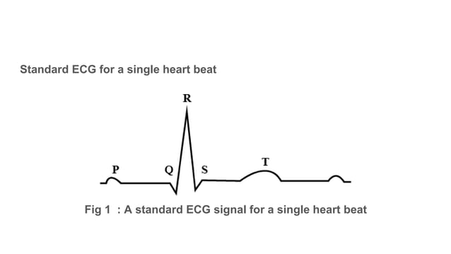 Myocardial Infarction Detection Using Ecg Pptx