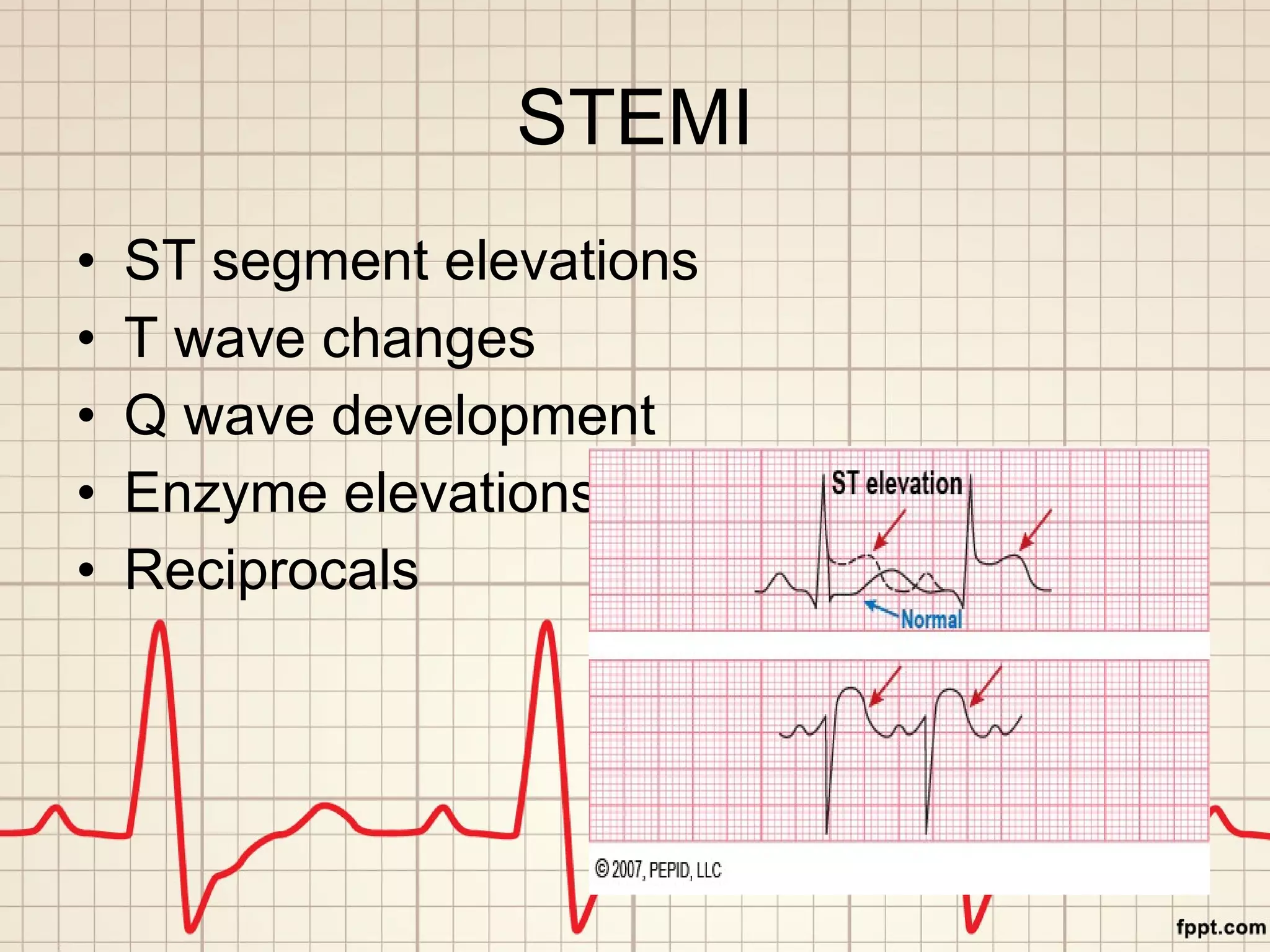 Myocardial infarction | PPT