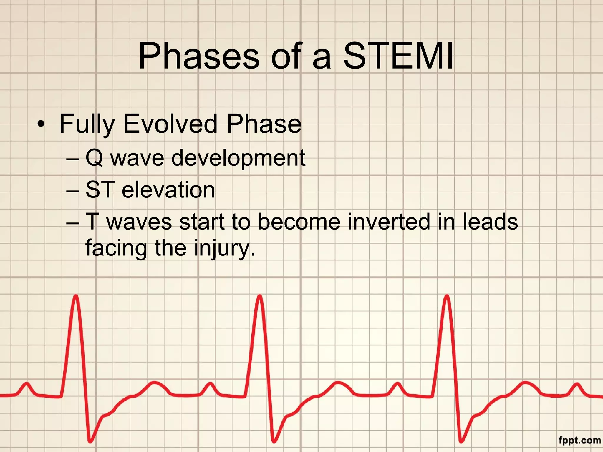 Myocardial infarction | PPT