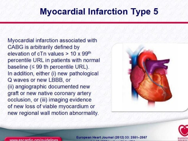 Myocardial Infarction Clinical Picture Investigations European Guidl…
