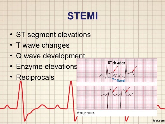 Myocardial infarction