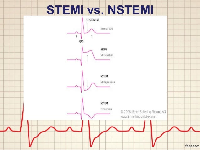 Myocardial infarction