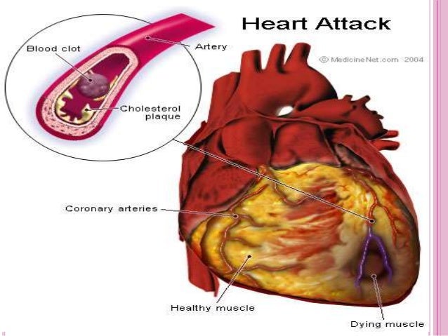 Myocardial infarction