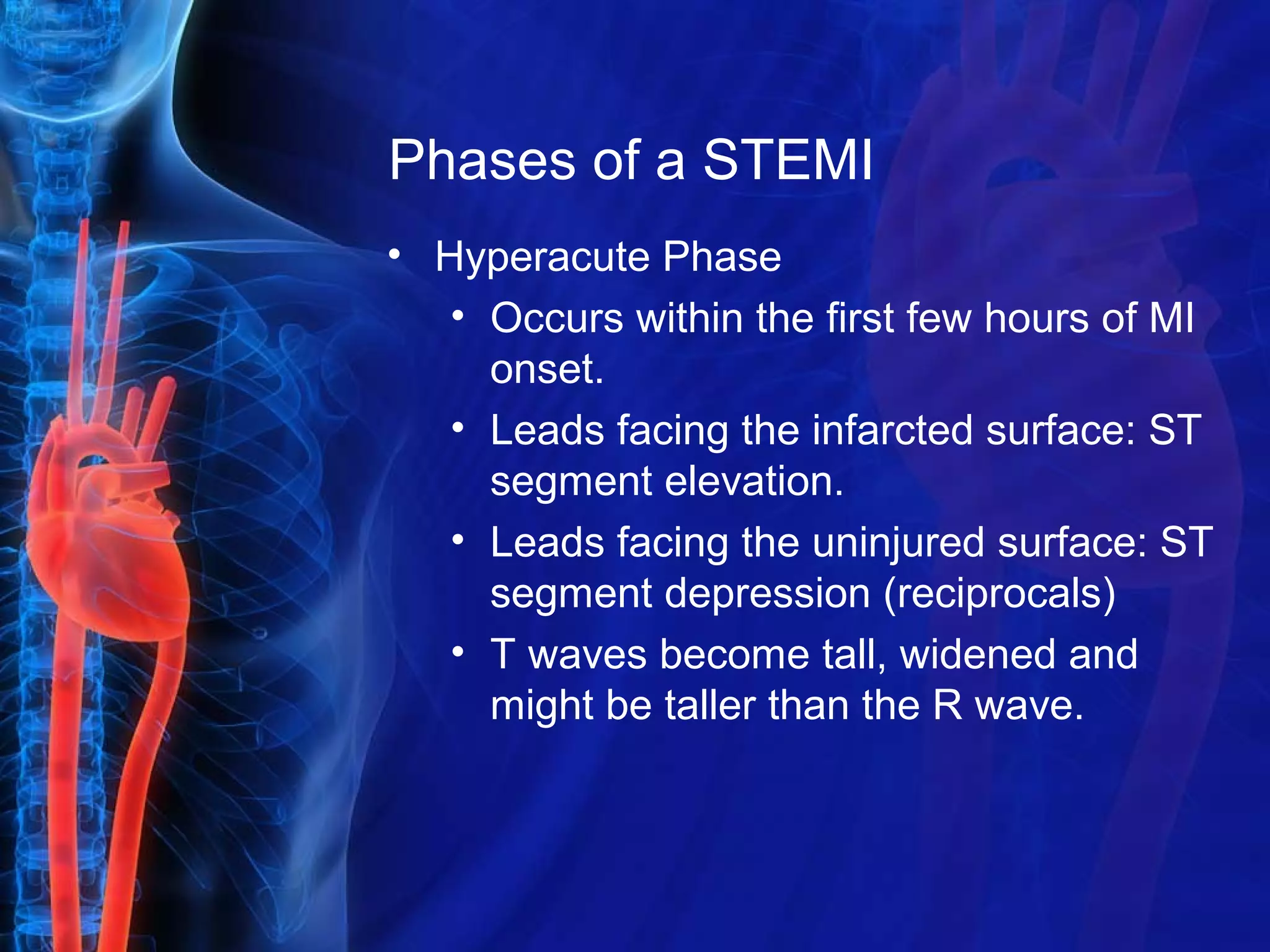 Myocardial infarction | PPT