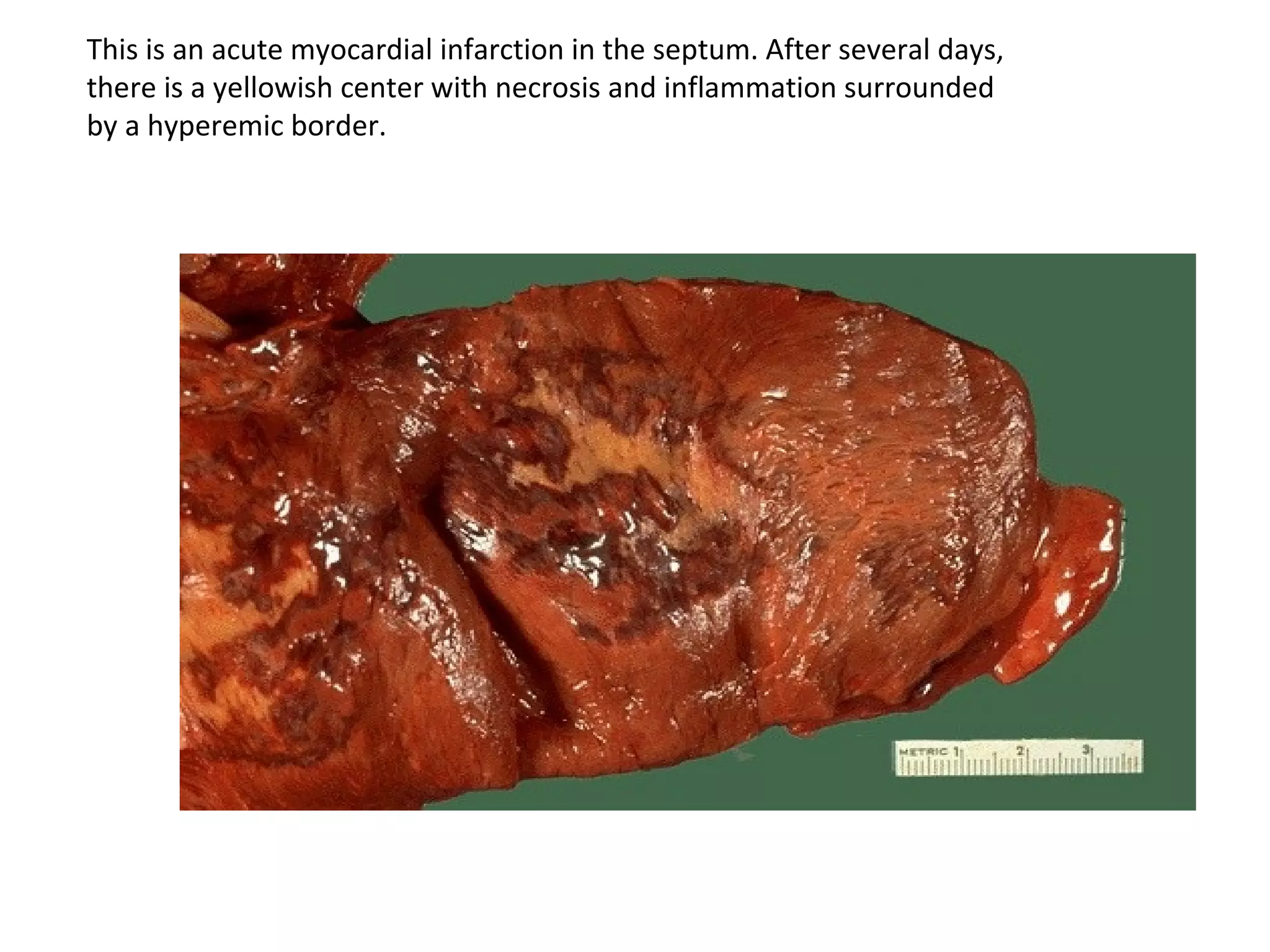 Myocardial infarction | PPT