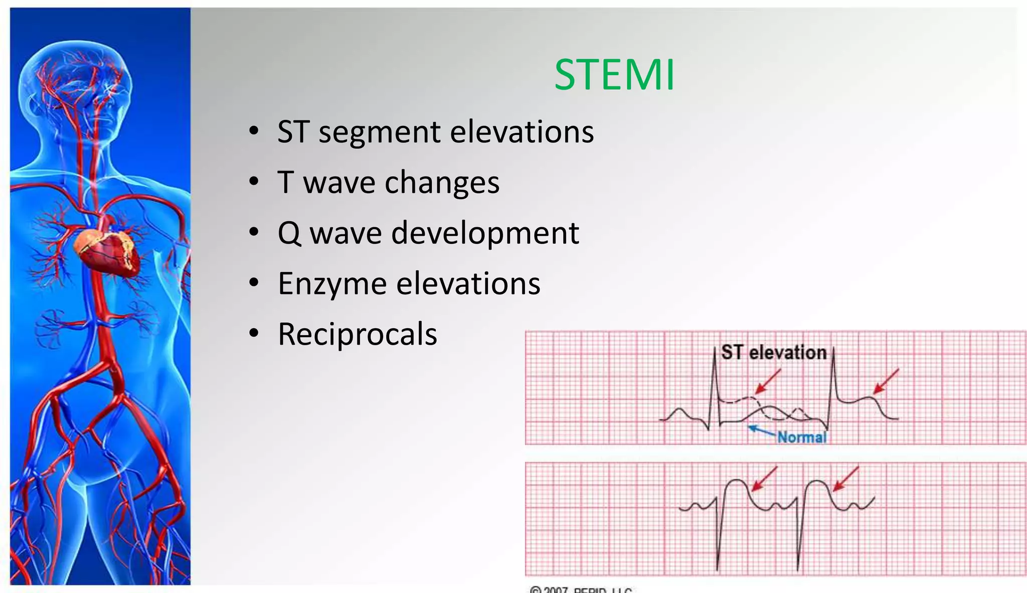 Myocardial infarction | PPTX
