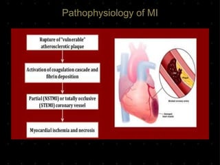 Myocardial infarction | PPTX