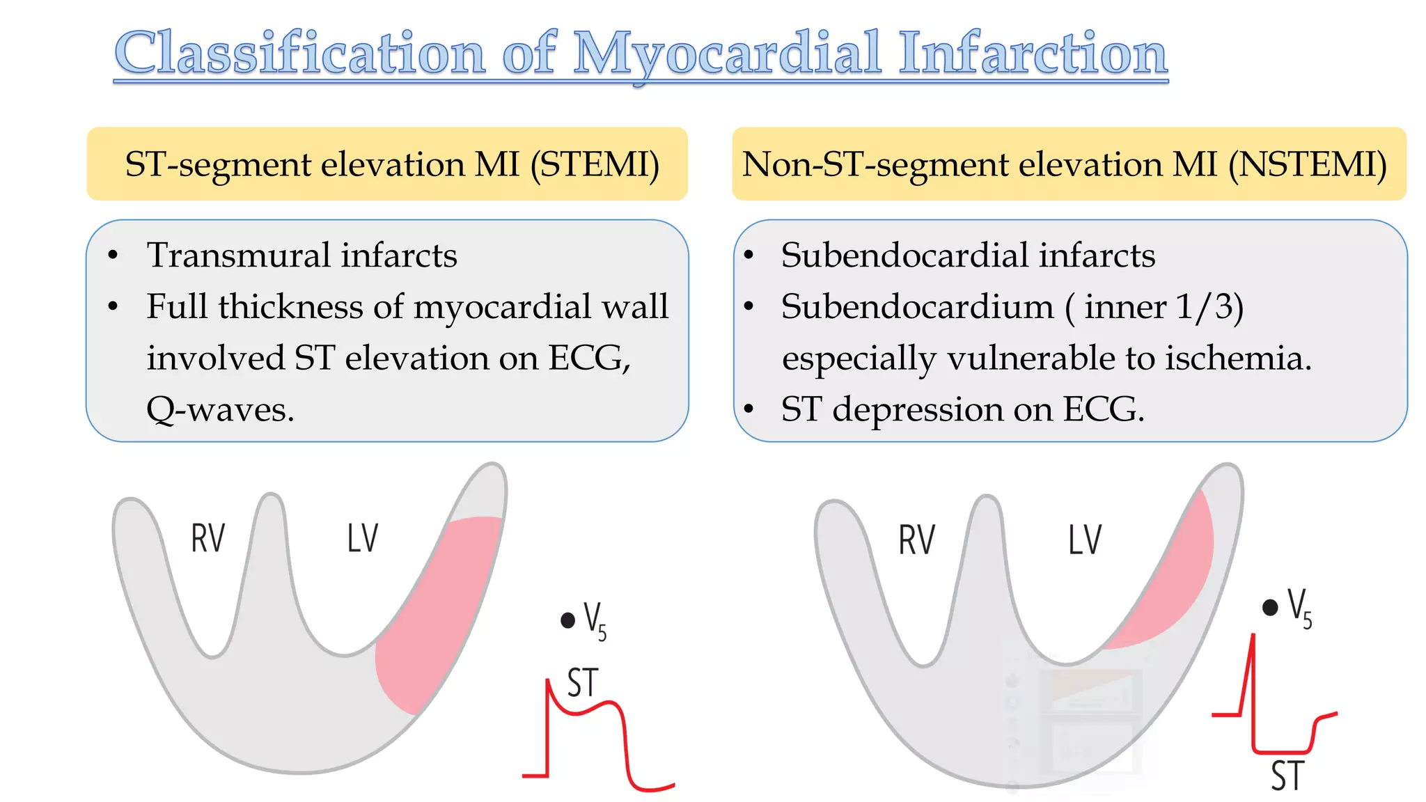 Myocardial infarction - Medicalbooksvn.wordpress.com