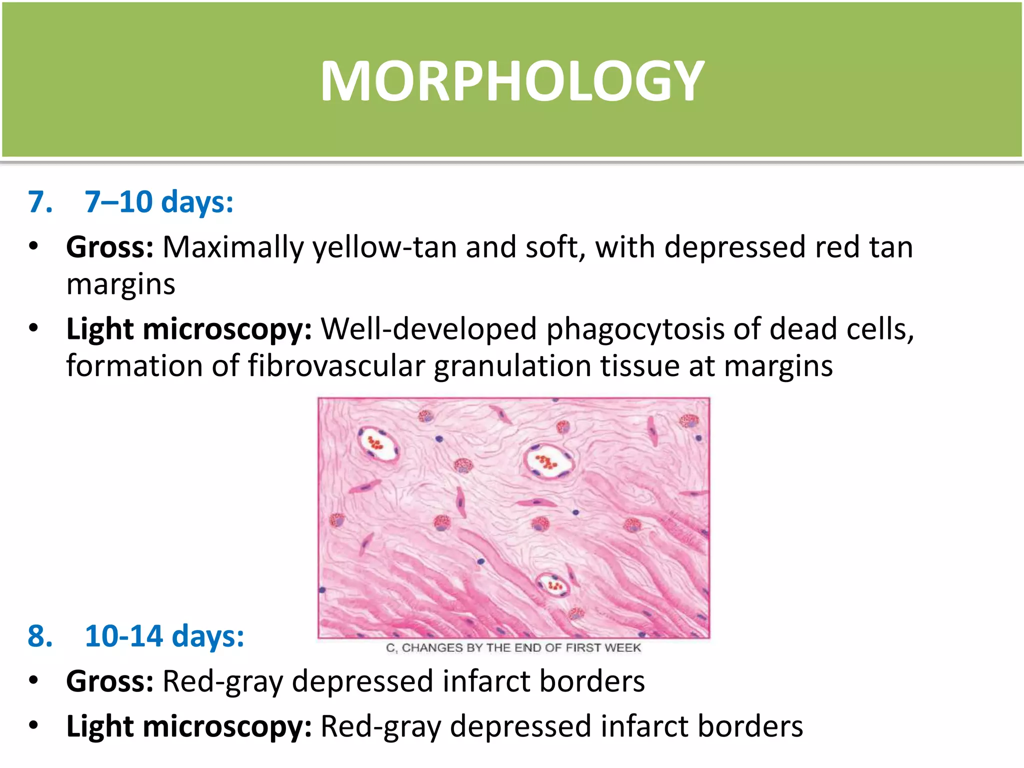 Pathogenesis And Morphological changes of Myocardial Infarction | PPTX