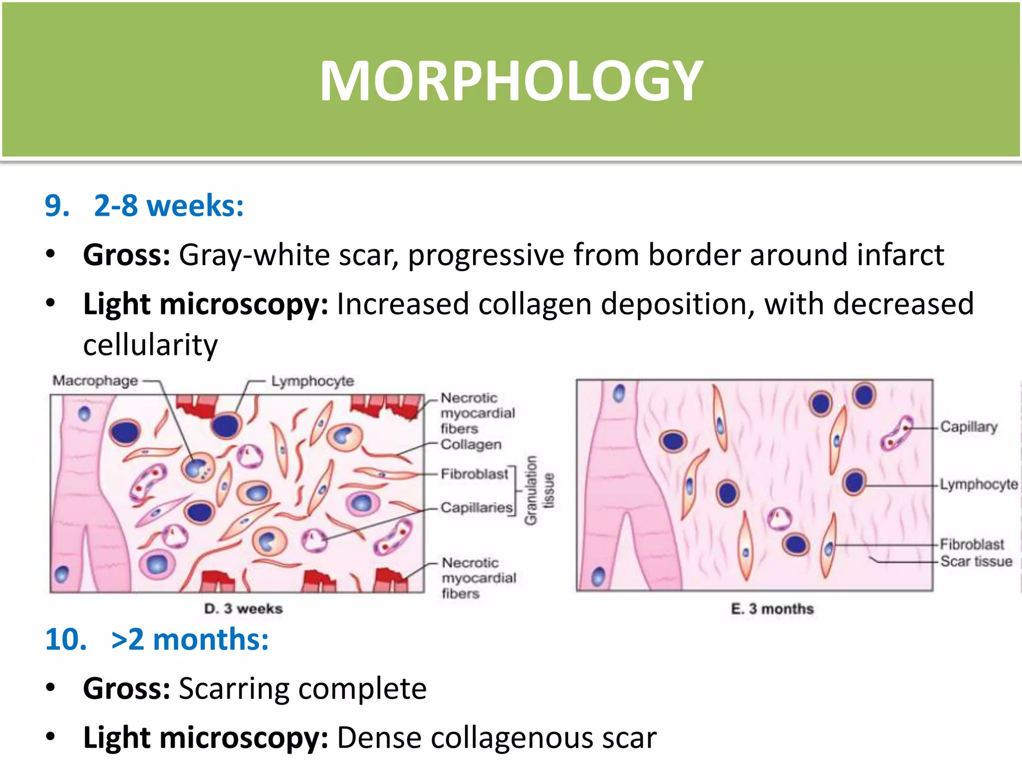 Pathogenesis And Morphological changes of Myocardial Infarction | PPTX