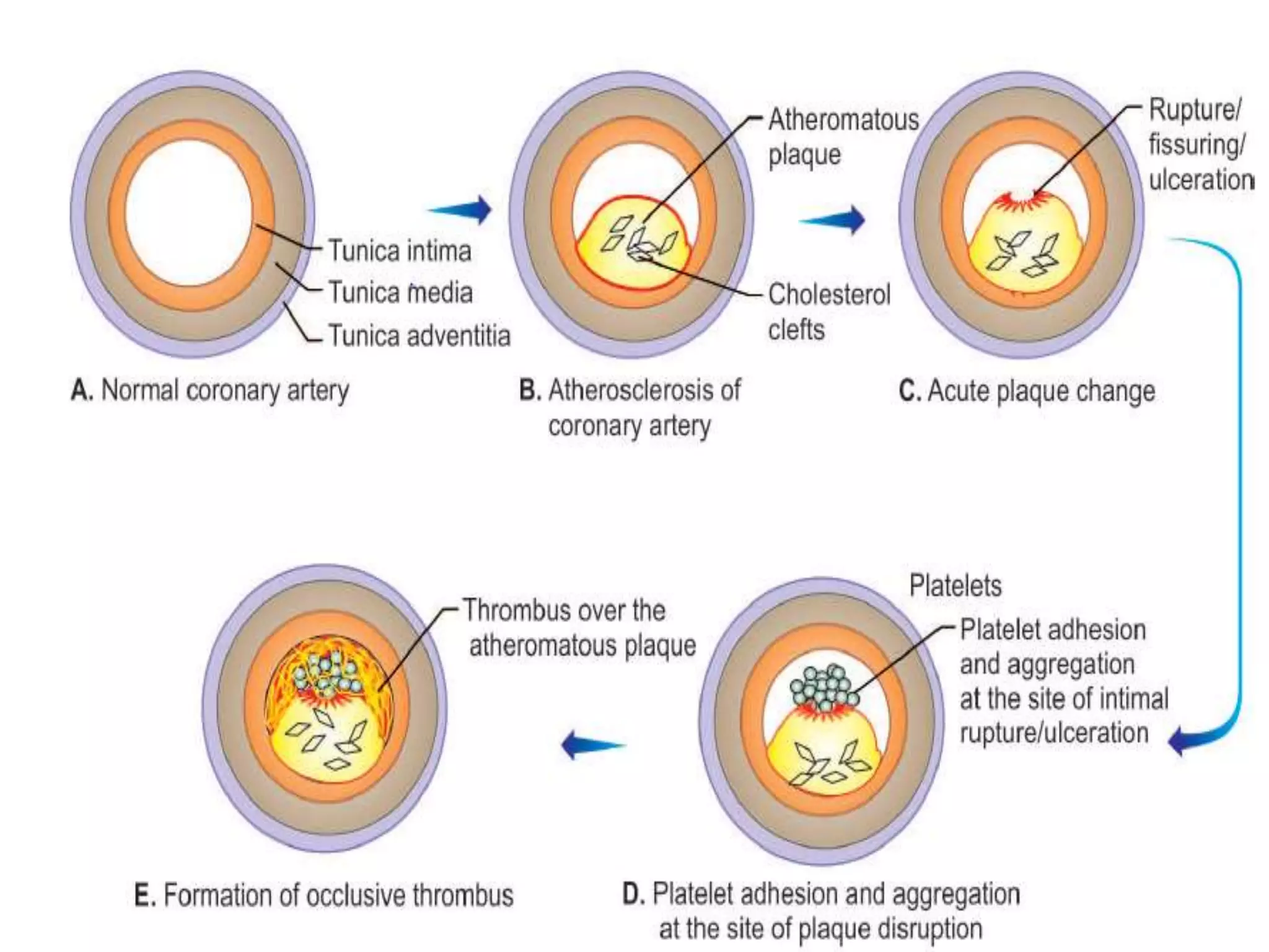 Pathogenesis And Morphological changes of Myocardial Infarction | PPTX