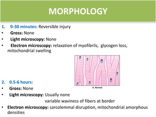 Pathogenesis And Morphological changes of Myocardial Infarction | PPTX