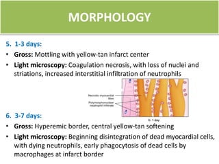 Pathogenesis And Morphological changes of Myocardial Infarction | PPTX