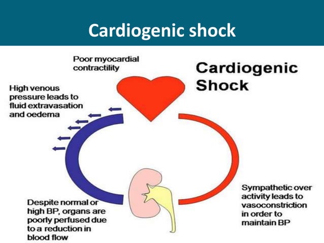 Myocardial infarction
