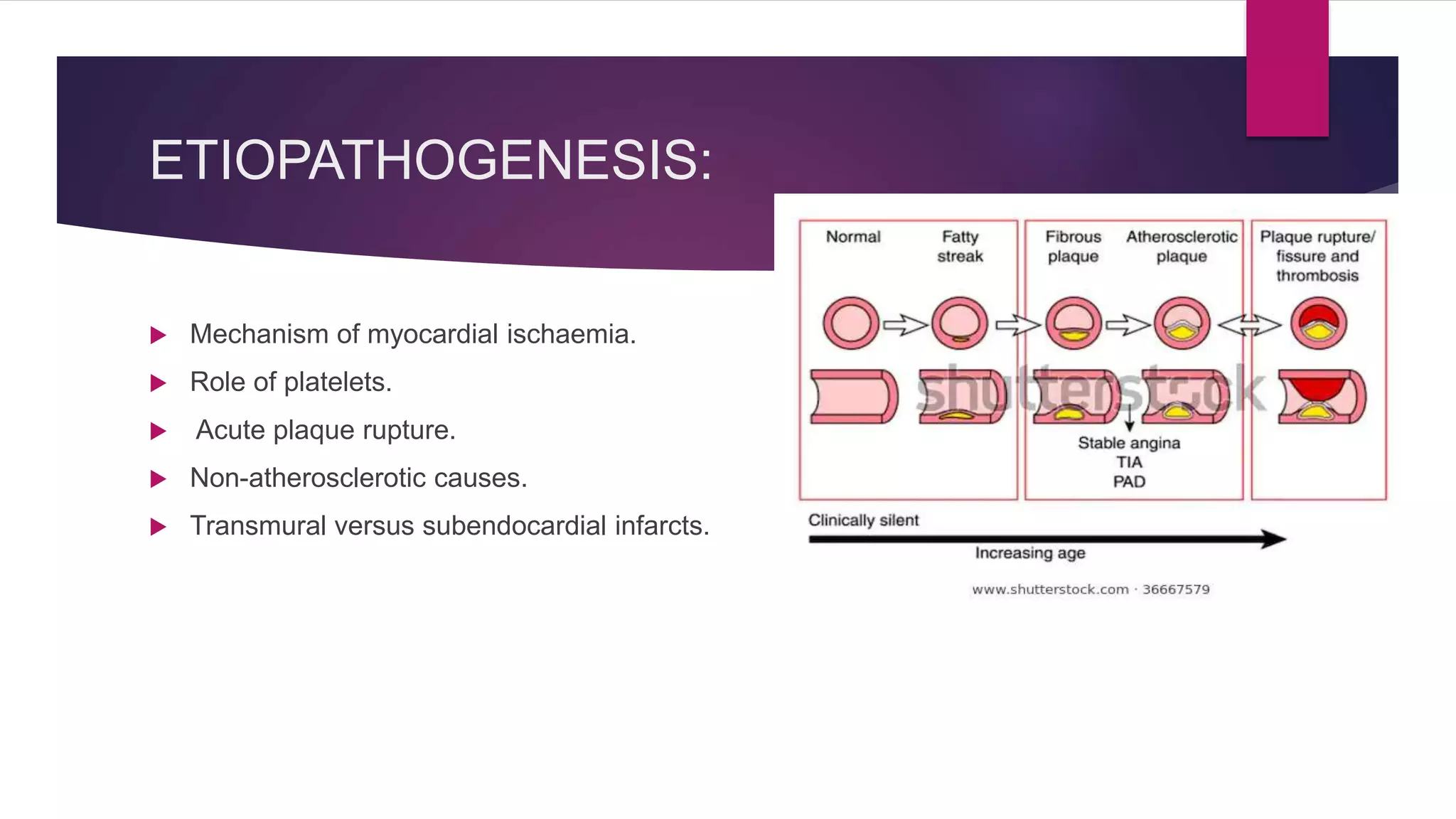 Myocardial infarction | PPTX