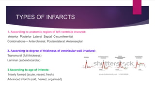 Myocardial infarction | PPTX