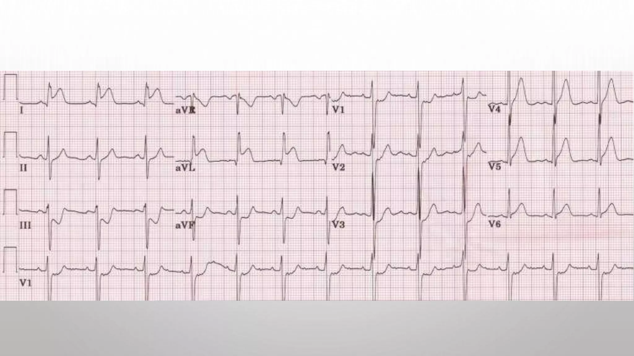 Myocardial infarction: introduction, clinical manifestation ...