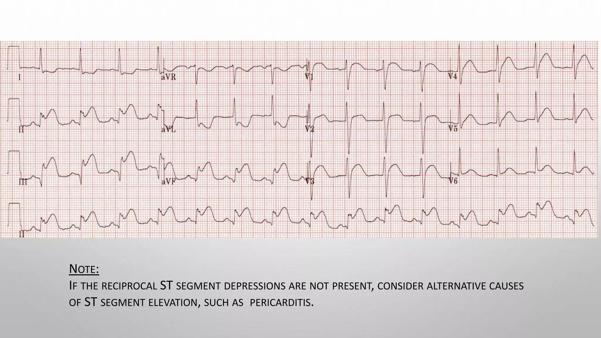 Myocardial infarction: introduction, clinical manifestation ...