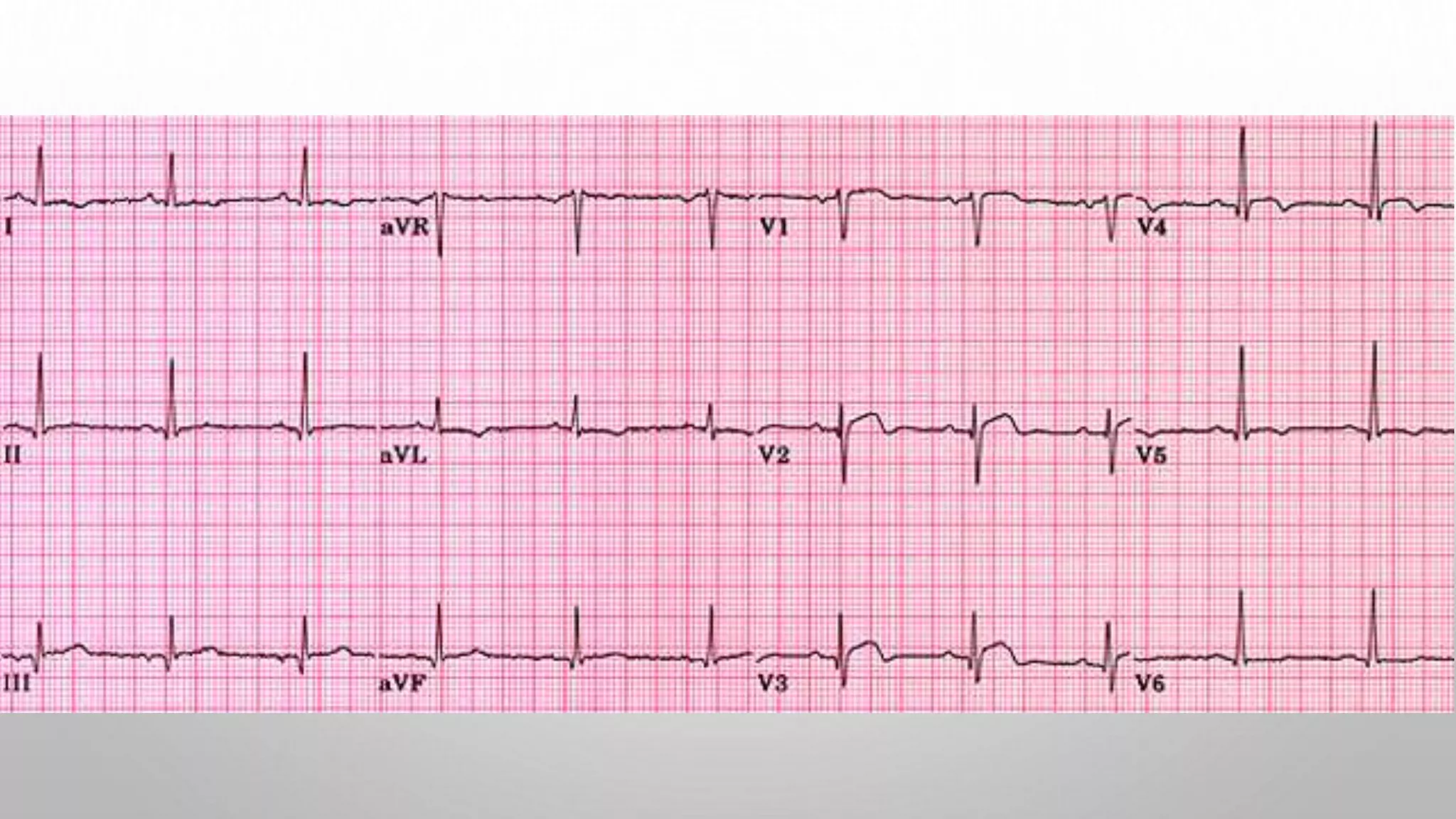 Myocardial infarction: introduction, clinical manifestation ...