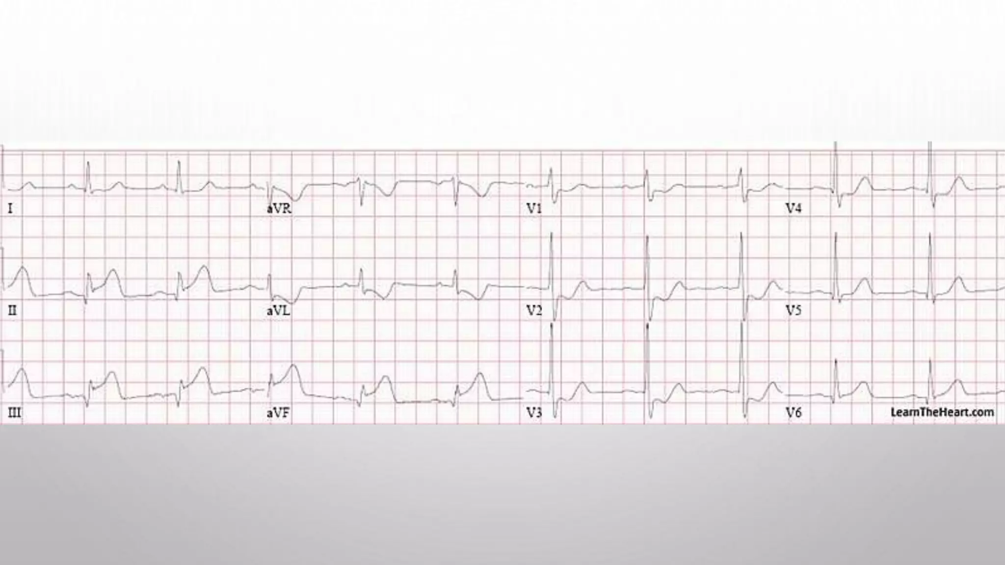 Myocardial infarction: introduction, clinical manifestation ...