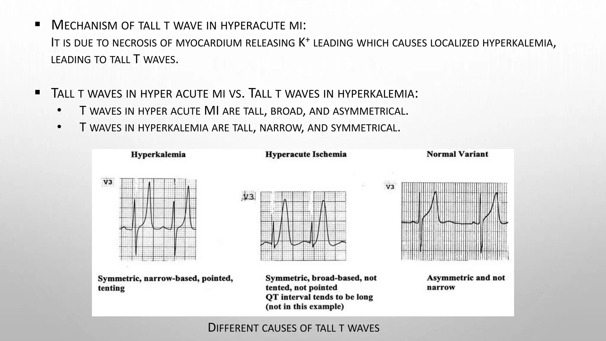 Myocardial Infarction Introduction Clinical Manifestation Classification Ecg Interpretation